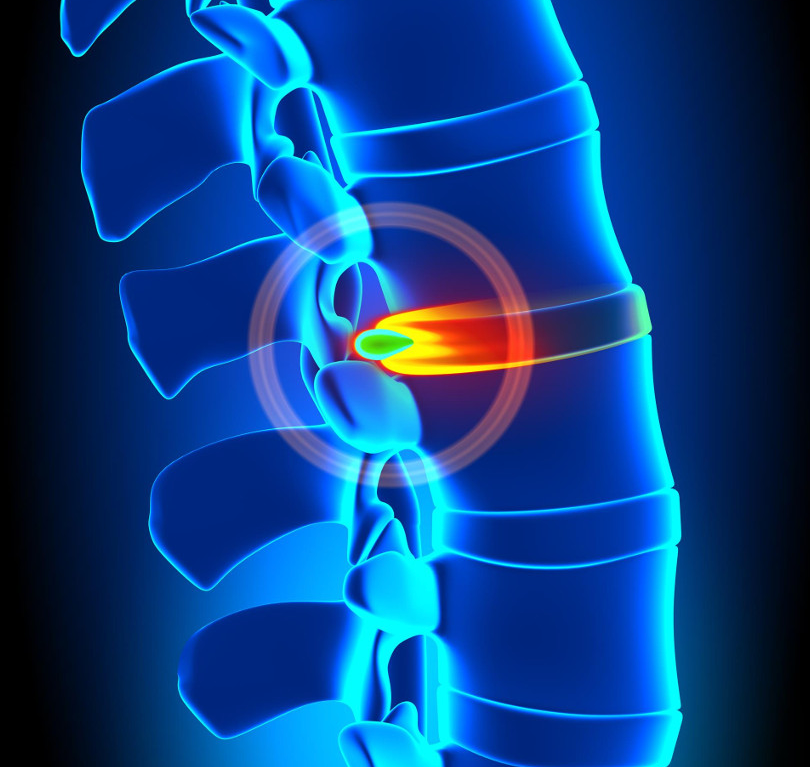 VARMA – LUMB SPINAL STENOSIS | Manhattan Spine Consultants